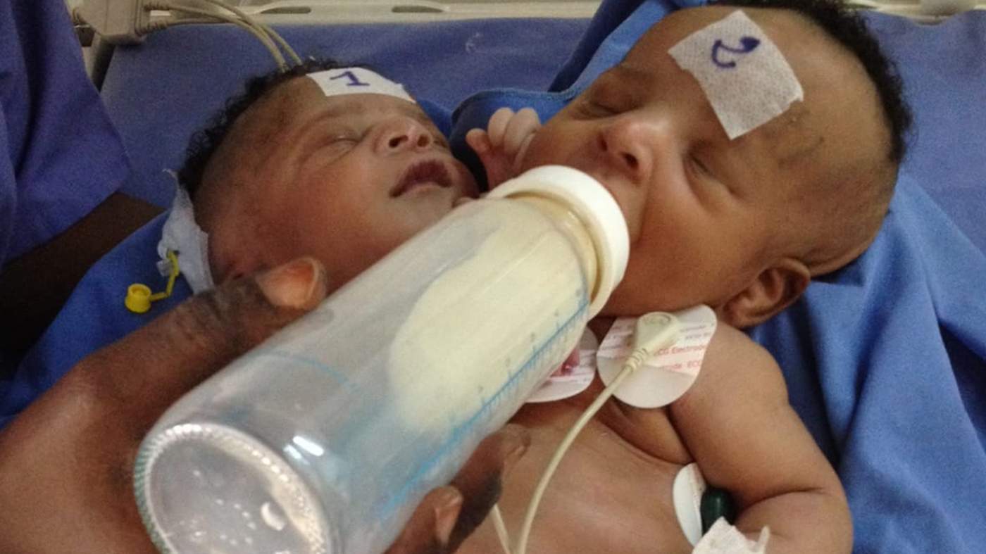 Two girls, one body - BBC News